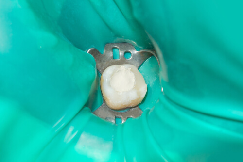 When you are having tooth pain after a filling | deanarmstrongdds.com