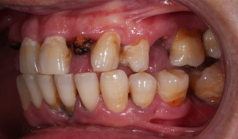 Facts About Oral Crohn's Disease | deanarmstrongdds.com