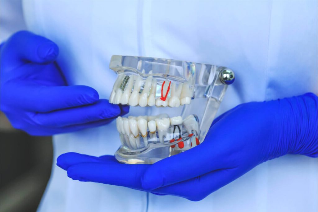 What Are The Reasons For Gum Infection After Root Canal?
